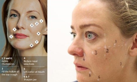 Cheek augmentation - Enhance Me Training Academy