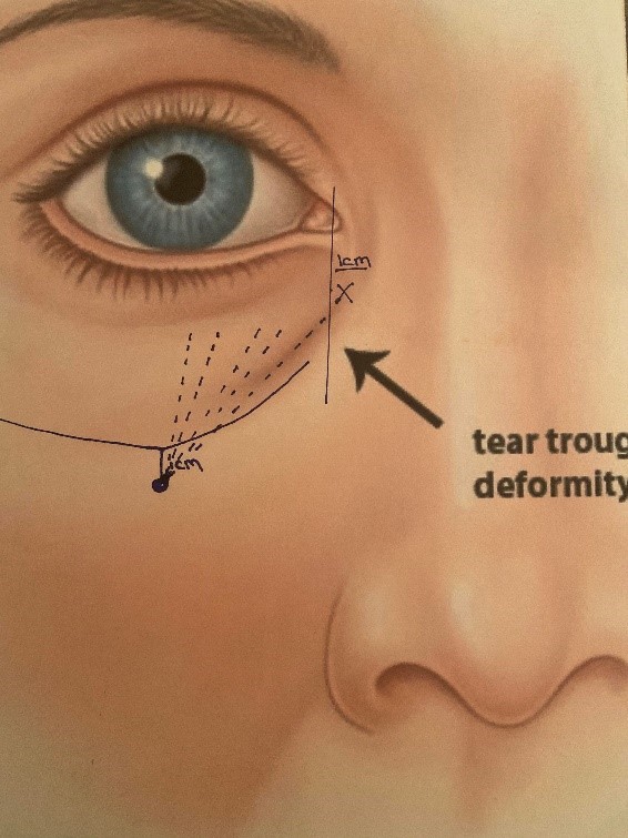What are tear Troughs? - Enhance Me Training Academy