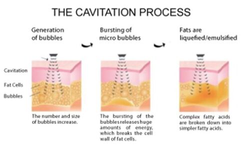 Cavitation with ultrasound - Enhance Me Training Academy